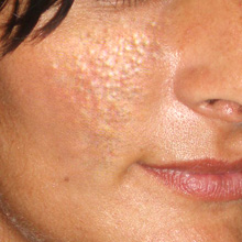 Tipos de acné - Tipos De